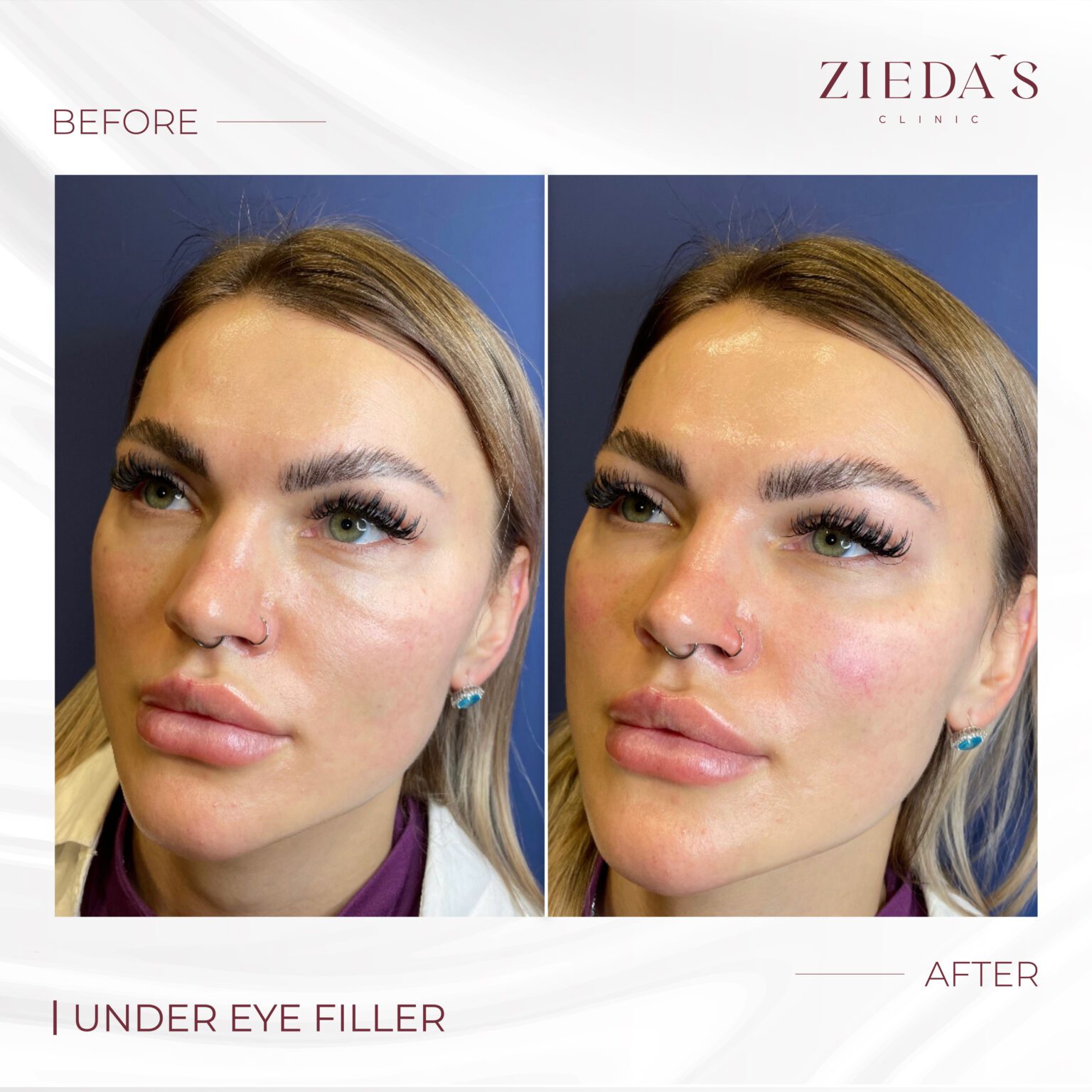 Under Eye Filler in Dubai | Dermal Fillers Under Eyes in UAE